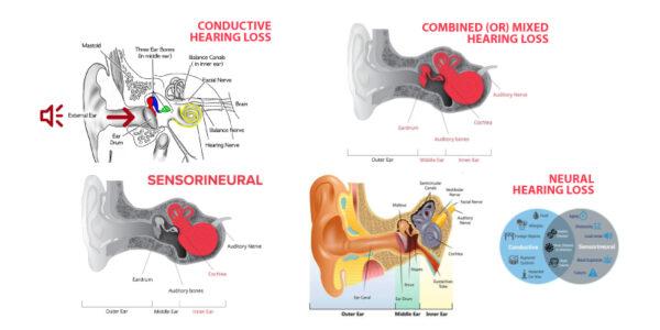 Types of Hearing Loss - Mixed Hearing Loss - Neural Hearing Loss